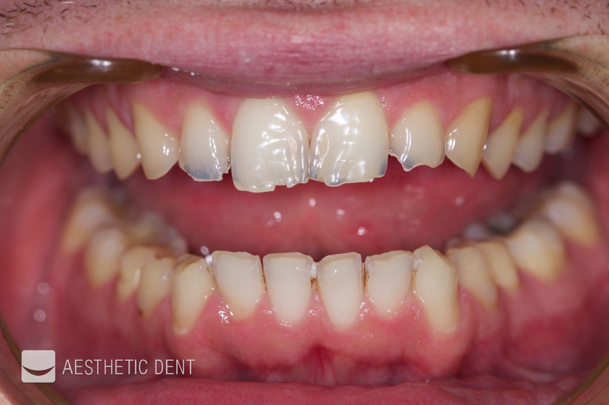 Licówki i kompozyty | Aesthetic Dent